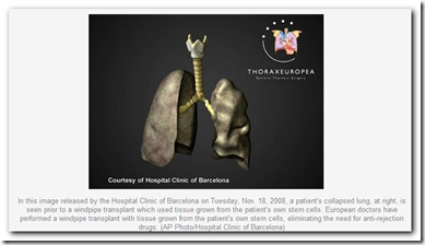Doctors transplant windpipe with stem cells - Medical Quack